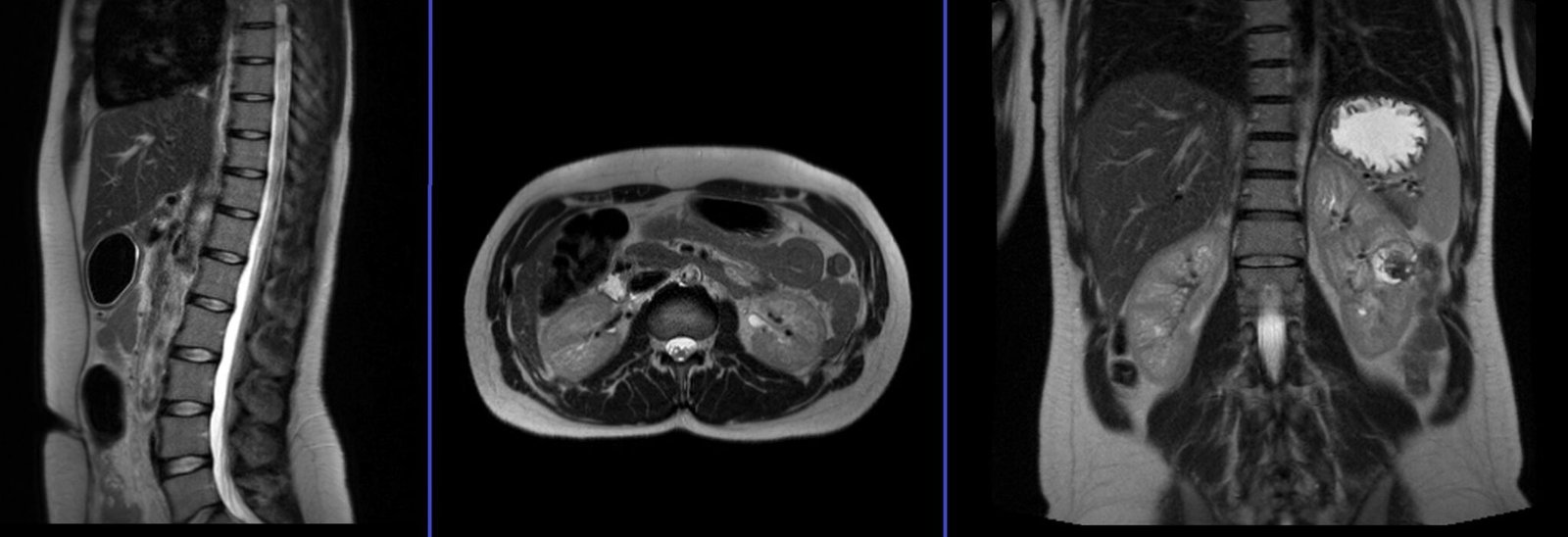 MRI Renal Angiography (MRA kidneys) Protocols and Planning and Indications