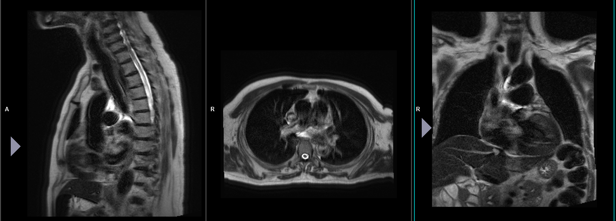 MRI Sternoclavicular Joint Protocol, Planning and Incications