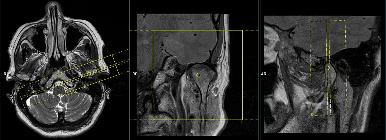 Temporomandibular Joints (TMJ'S) MRI Planning and Protocols ...