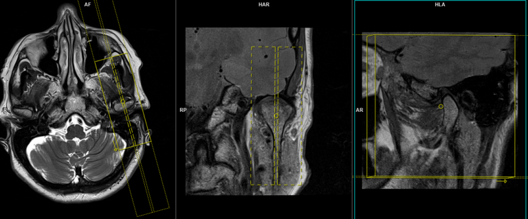 Temporomandibular Joints (TMJ'S) MRI Planning and Protocols ...