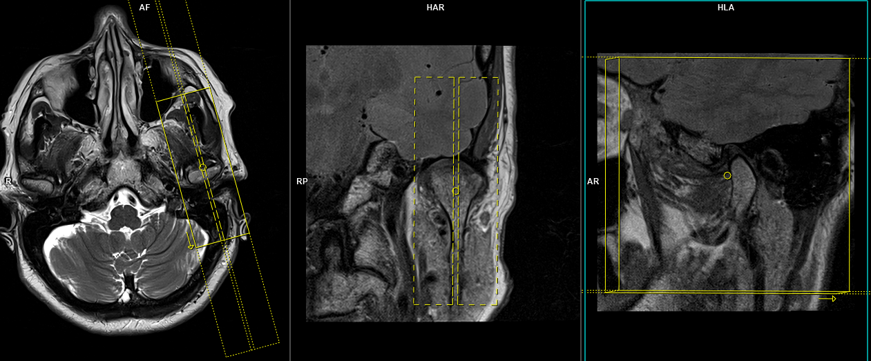 Temporomandibular Joints (TMJ'S) MRI Planning and Protocols ...