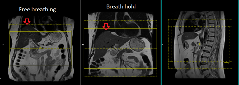 MRCP Planning |MRCP Protocols | Indications for MRI ...
