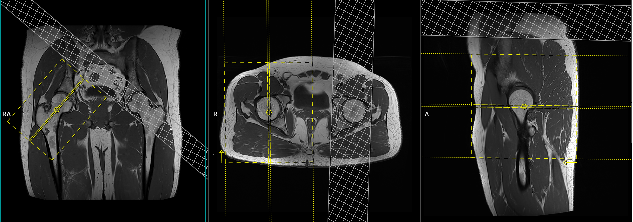MRI Hip | MRI HIP Unilateral Protocol and Planning