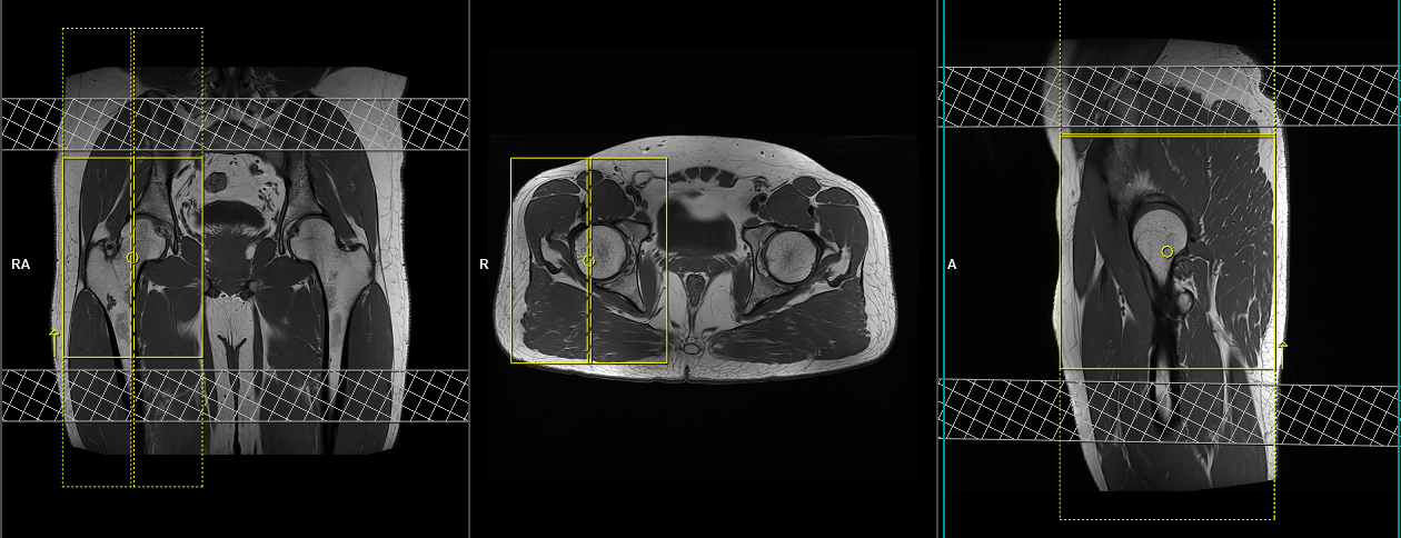 MRI Hips Protocols and Planning | Indications for MRI Hips Scan