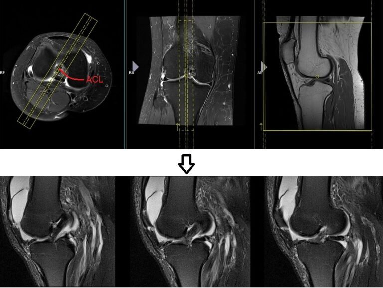 MRI Knee Protocols and Planning | Indications for MRI Knee Scan