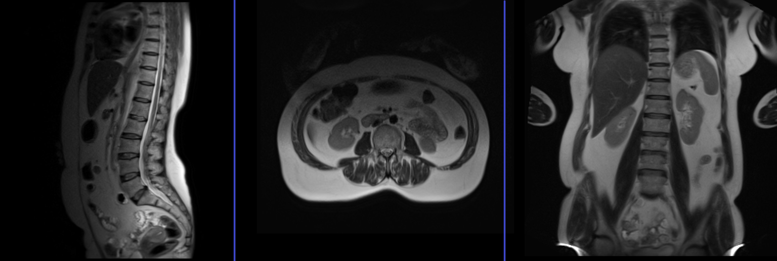 MRI whole spine | MRI whole spine protocol and planning
