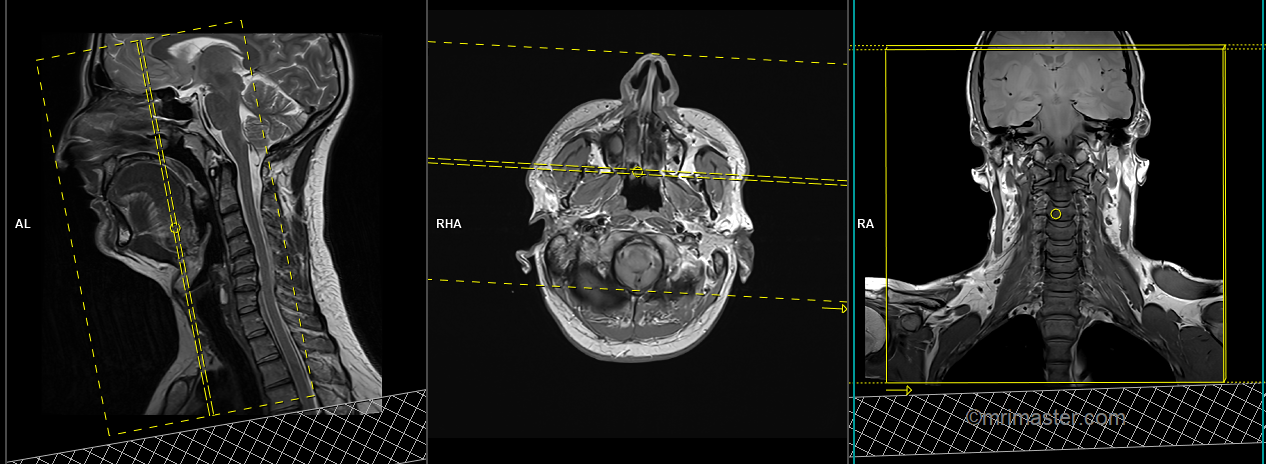 MRI soft tissue neck planning and protocols | Indications for MRI neck scan