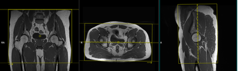 MSK Pelvis MRI protocol and planning | MRI Musculoskeletal(MSK) Pelvis