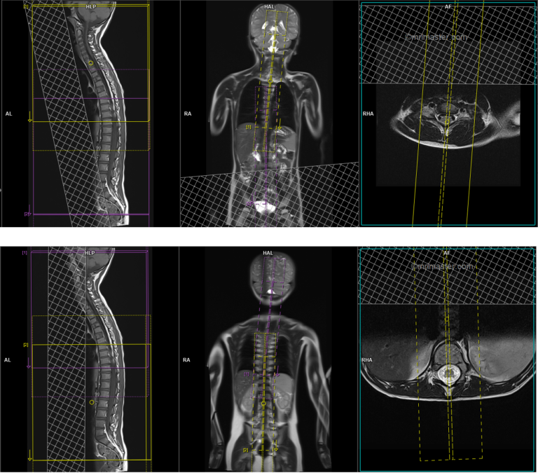 MRI pediatric spine | MRI pediatric whole spine protocol and planning