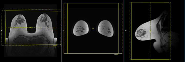 Mri Sequences And How To Read A Breast Mri And Bi-Rads – VFIGOM