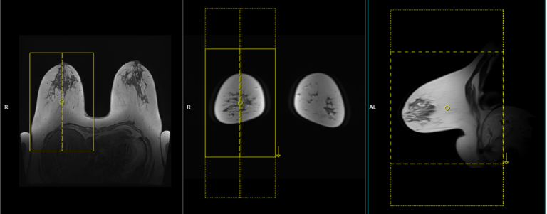 MRI Breast Scan Protocols and Planning | Indications for MRI Breast