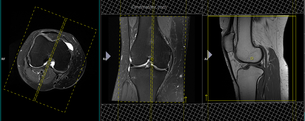 MRI Knee Protocols and Planning | Indications for MRI Knee Scan
