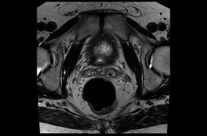 PROSTATE axial t2 high resolution images - mrimaster