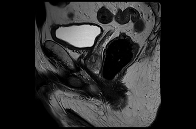 PROSTATE MRI 3T T2 sagittal images - mrimaster