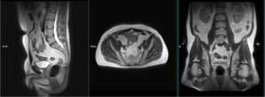 MRI Prostate Protocols | MRI Prostate Cancer Multiparametric planning
