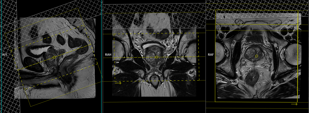 Mri Prostate Protocols Mri Prostate Cancer Multiparametric Planning