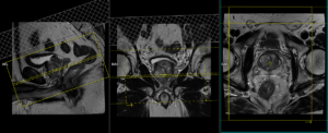 MRI Prostate Protocols | MRI Prostate Cancer Multiparametric planning