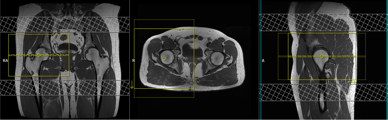 MRI Hip | MRI HIP Unilateral Protocol and Planning