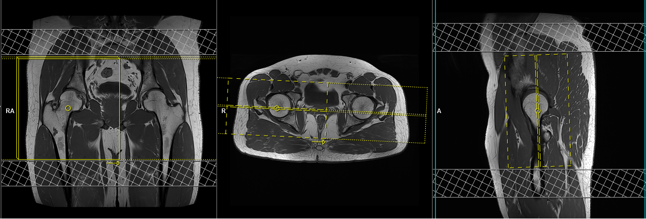 MRI Hip | MRI HIP Unilateral Protocol and Planning