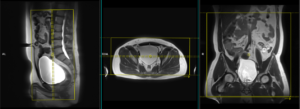 Urinary bladder MRI Protocols and Planning | Indications for MRI ...