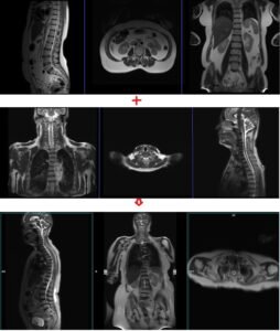 mri full spine | MRI whole spine automatic composing protocol and planning