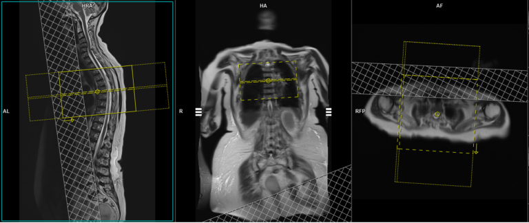 mri full spine | MRI whole spine automatic composing protocol and planning