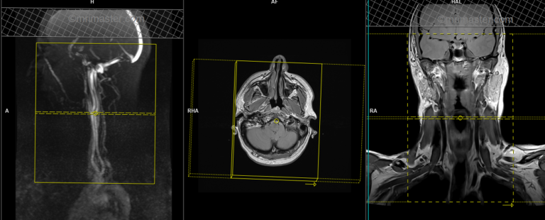 Magnetic Resonance Angiography( MRA) Neck Dissection Protocols and Planning