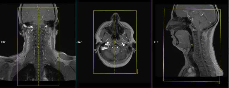 Magnetic Resonance Angiography( MRA) Neck Dissection Protocols and Planning