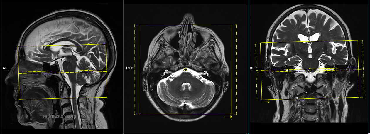 Malignant Otitis Externa (MOE) MRI Protocols and Planning | MRI ...