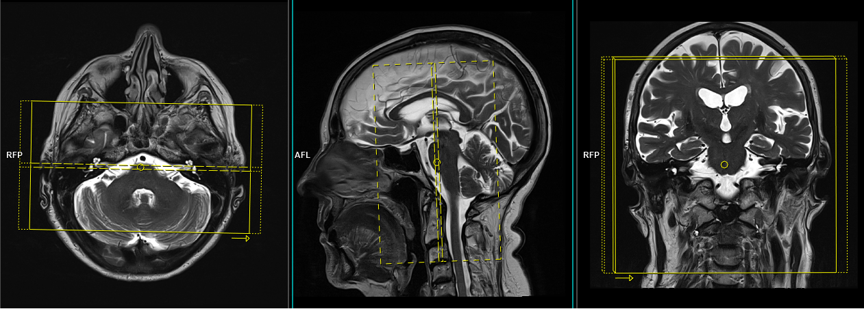 Malignant Otitis Externa (MOE) MRI Protocols and Planning | MRI ...