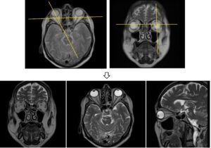 MRI Orbits Planning | Indications for MRI Orbits Scan| MRI Orbits Protocols