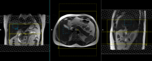 Pancreas MRI Respiratory Gated Protocol and Planning | MRI MRCP Pancreas