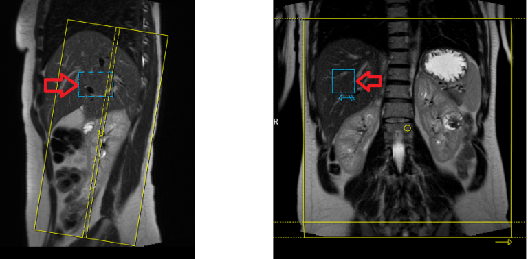 MRI Kidneys Protocol | Renal MRI Protocol and Planning