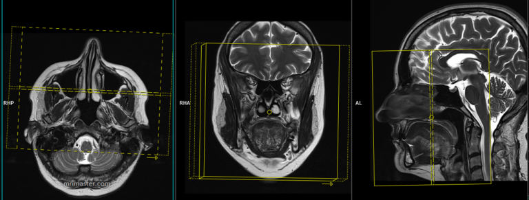 MRI Face (Oral Cavity) Protocols and Planning | Indications for MRI ...