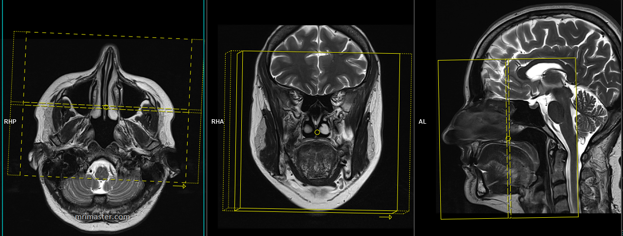 MRI Face (Oral Cavity) Protocols and Planning | Indications for MRI ...