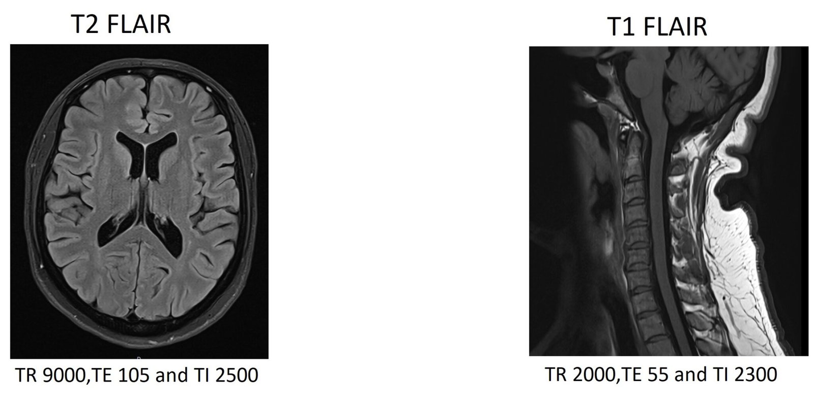 FLAIR MRI | FLAIR MRI Sequence Physics, Image and Pathology Appearance