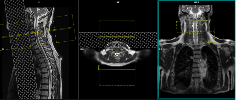 MRI whole spine | MRI whole spine protocol and planning