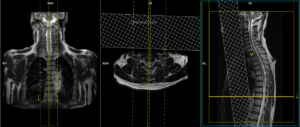 MRI whole spine | MRI whole spine protocol and planning