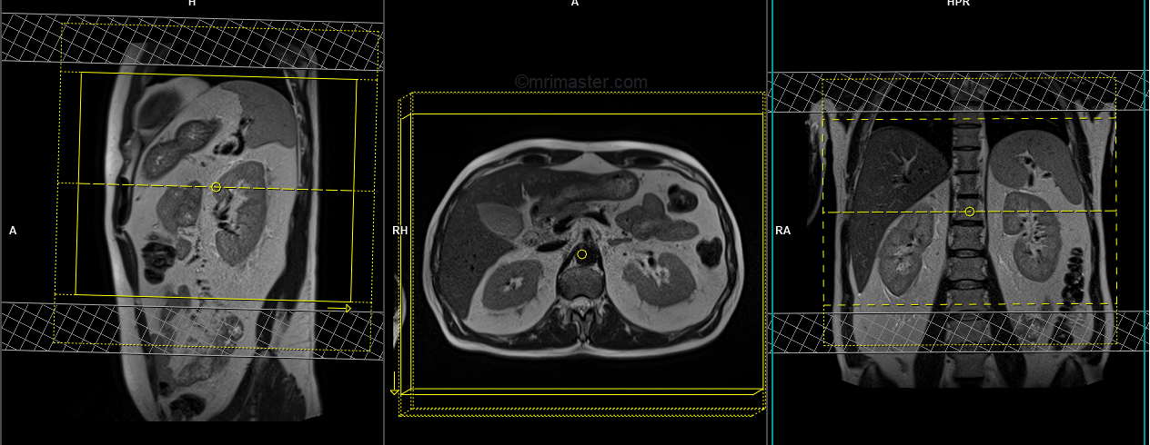 MRI Adrenal Glands: Protocol, Planning, Positioning, and Indications.