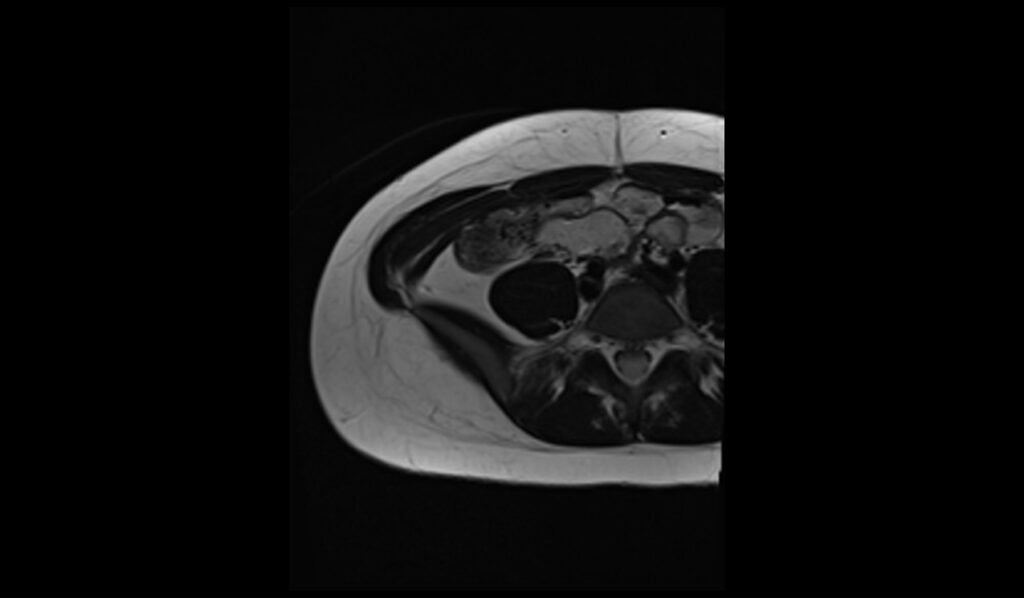 appendix MRI T2 tse axial images