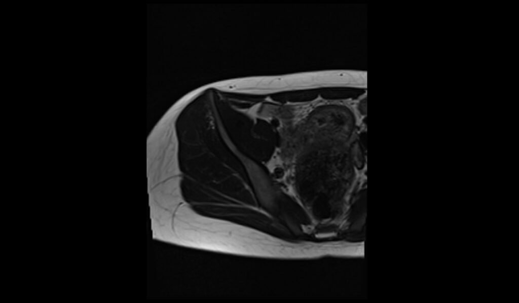 appendix MRI T2 tse axial images
