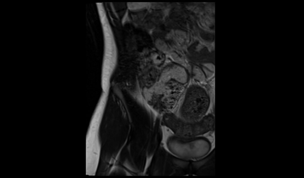 appendix MRI T2 tse coronal images