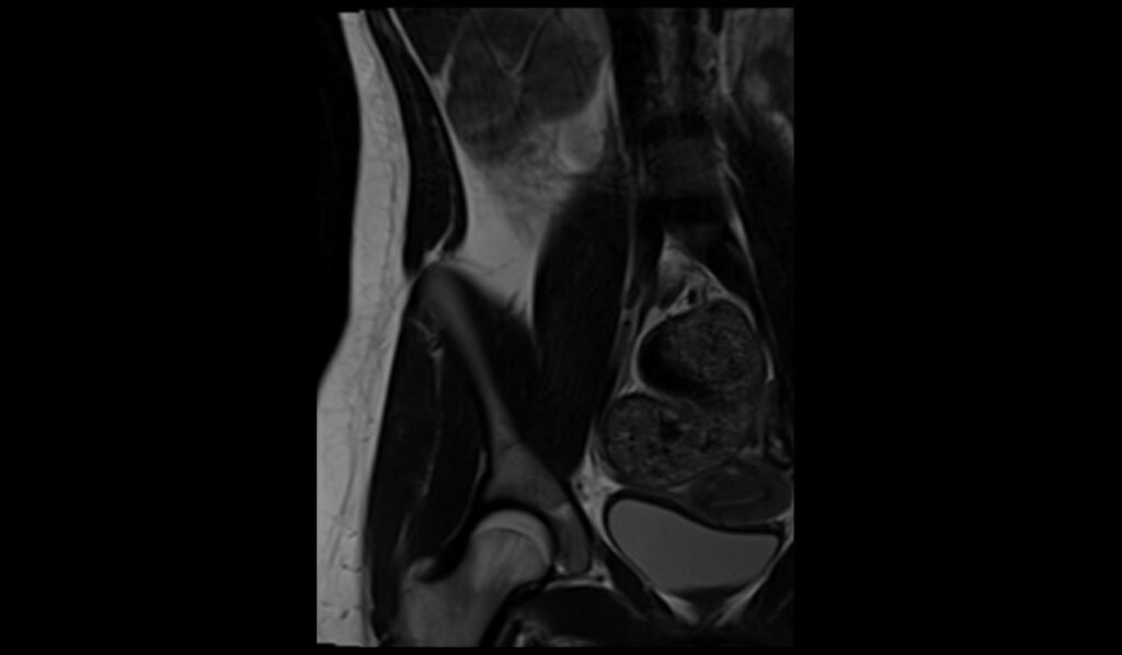 appendix MRI T2 tse coronal images