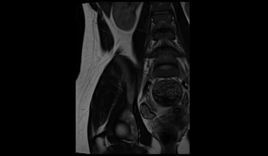 appendix MRI T2 tse coronal images