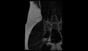 appendix MRI T2 tse coronal images