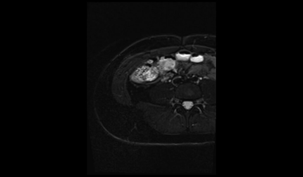 appendix MRI T2 tse fat sat axial images