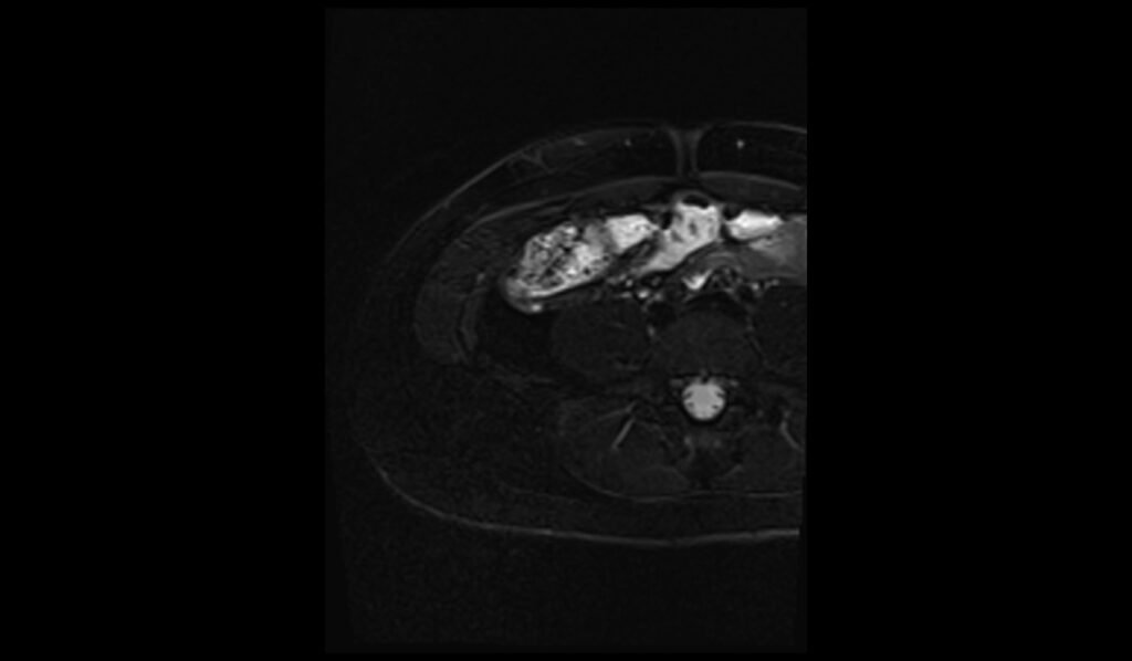 appendix MRI T2 tse fat sat axial images