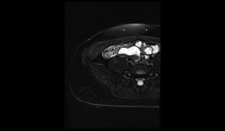 appendix MRI T2 tse fat sat axial images