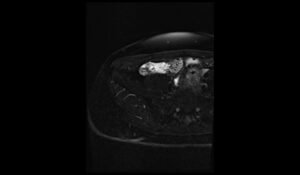appendix MRI T2 tse fat sat axial images