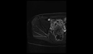 appendix MRI T2 tse fat sat axial images